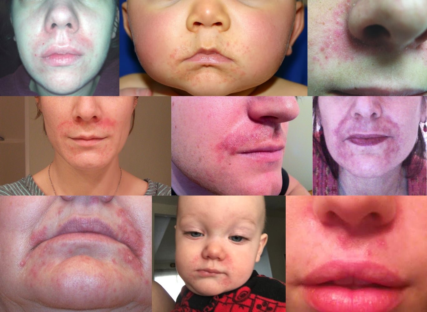 Six Steps to Heal Perioral Dermatitis Naturally and Effectively